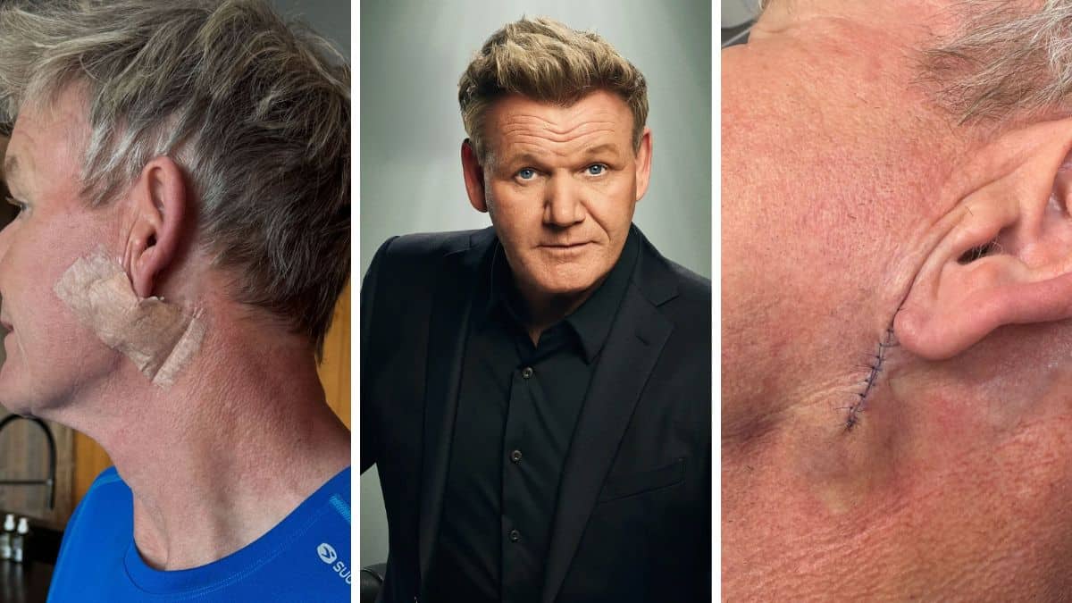 Gordon Ramsay's Skin Cancer Diagnosis And Warning To Fans - Taste of ...