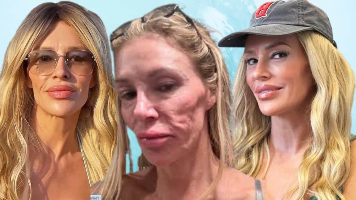 Brandi Glanville Got Plastic Surgery After Facial Disfigurement - Taste ...