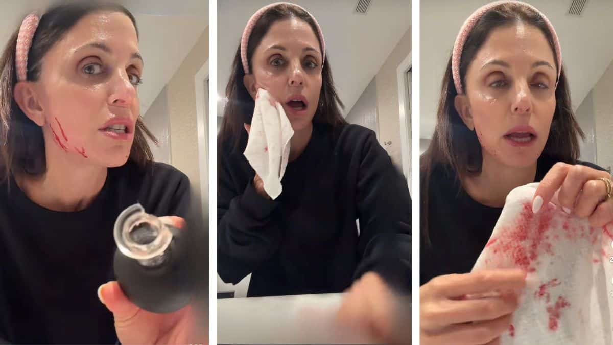 Bethenny Frankel Left With A Bloody Face After Trying A New Beauty ...
