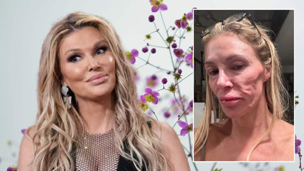 Brandi Glanville's Face Is "Sinking In Again" Despite Using Parasite ...